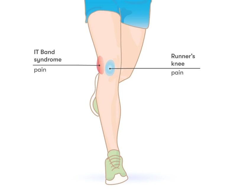 Centurion Orthopaedic Centre Iliotibial Band Syndrome - Centurion ...